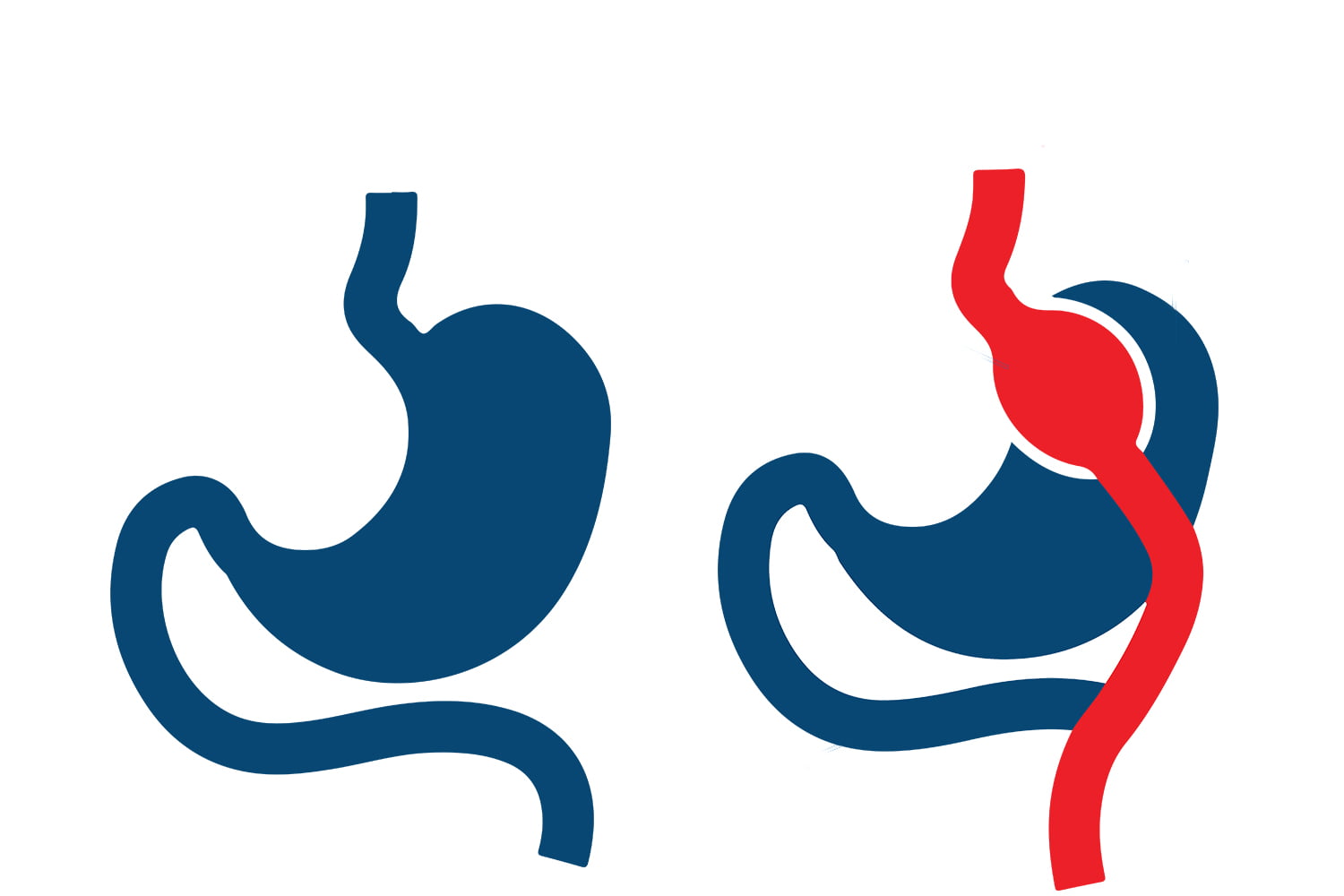 Mide küçültme ameliyatında kilo sınırı nedir? - Op.Dr. Mustafa Coşkun ...